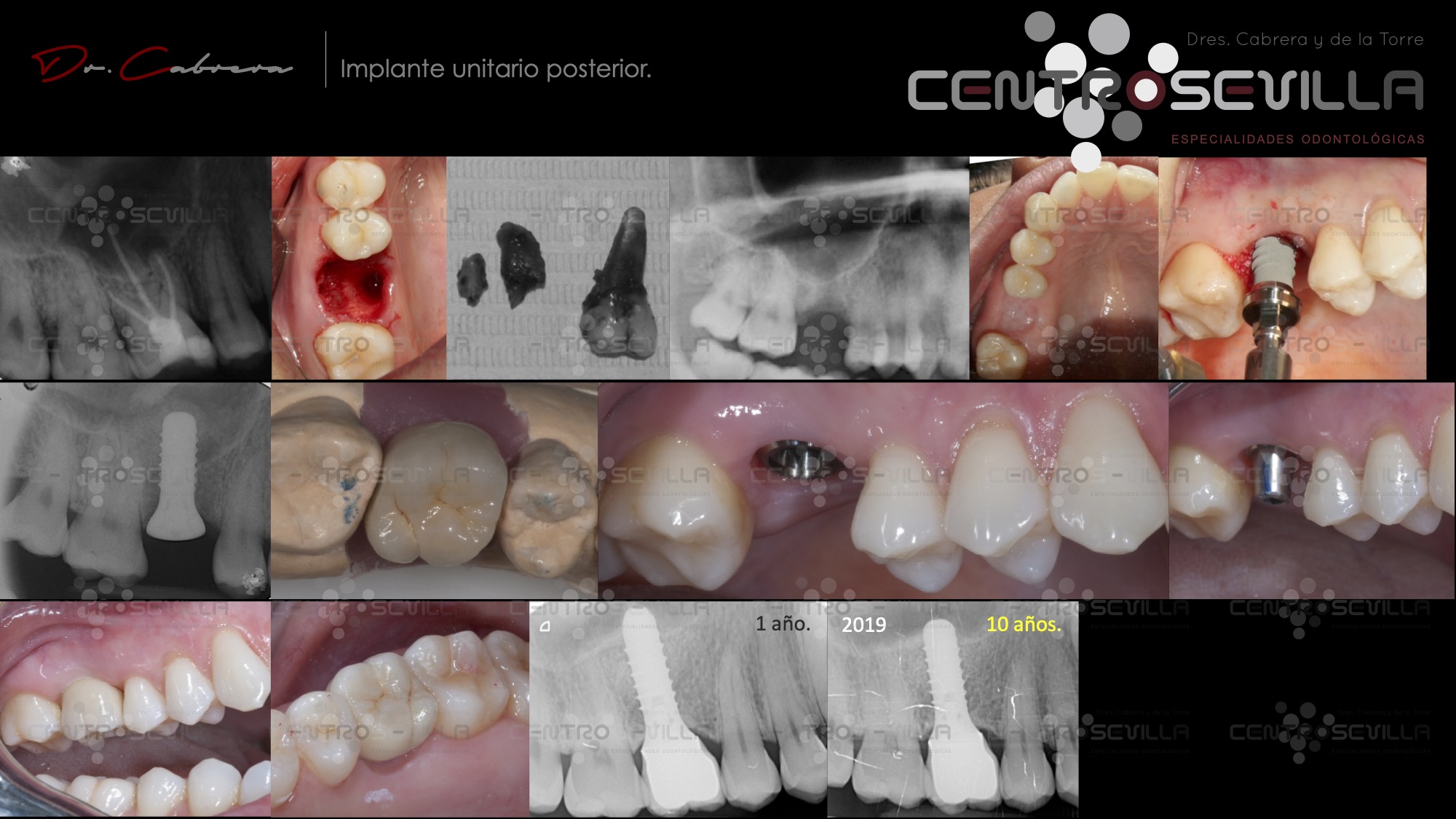 Implantología - Clínica Centro Sevilla